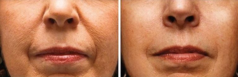 BELLAFILL Injections - nose and Skin care | Perfect Skin Center