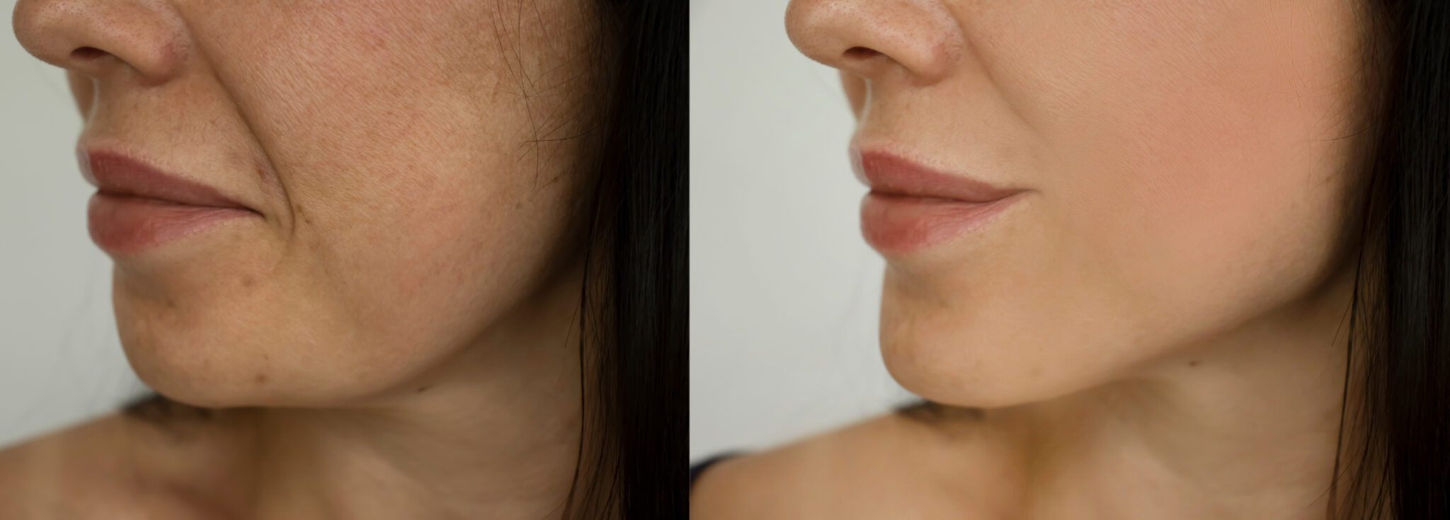 Skin Tightening Scottsdale AZ | Tempe AZ - Arizona Medspa | Perfect ...