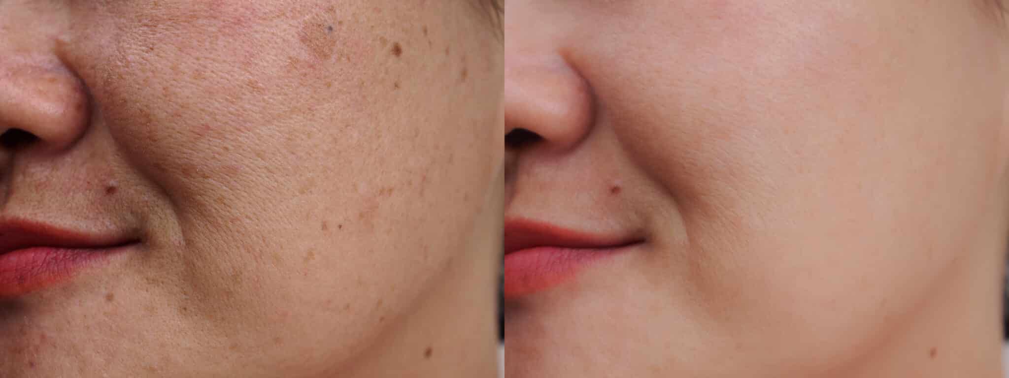 Sun Damage Treatment Scottsdale AZ | Tempe AZ - Arizona Medspa ...