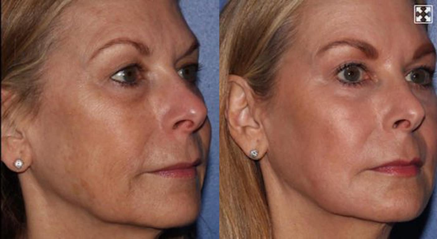 Rejuvenate Your Skin's Appearance with Laser Genesis™ in Tempe ...